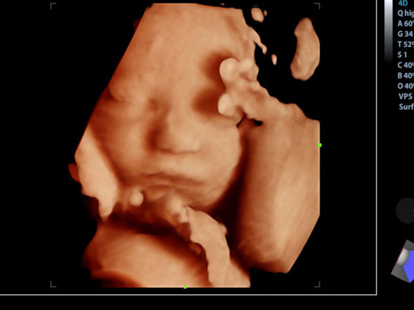 Ultrasonido 3D y 4D | Dr. Emmanuel Acuña