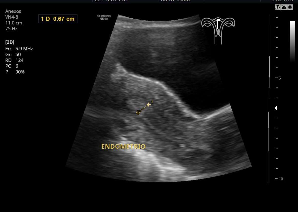 Ultrasonido Pélvico Ginecológico | Dr. Emmanuel Acuña